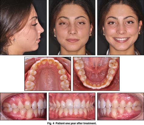 Class 2 Elastics Side Effects At Benjamin Hutchison Blog