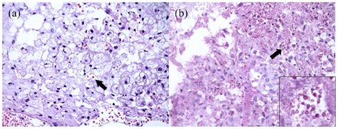 Cryptococcus Histology
