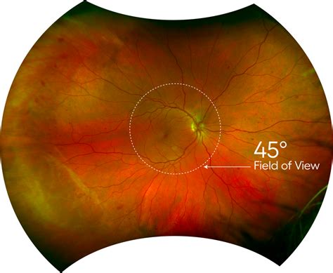 Retinopathy Retinopathy Fundoscopic Exam Diabetic Retinopathy