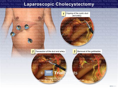 Laparoscopic Cholecystectomy Trialquest Inc
