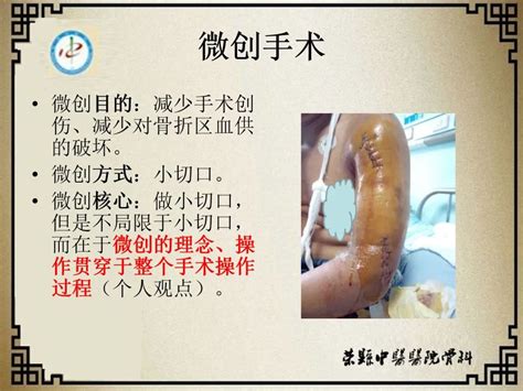 肱骨骨折闭合复位经皮锁定钢板前置内固定术！ 德医医学 助力医学教育发展！