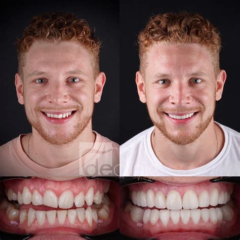 Gum Contouring Dental Excellence Turkey Dental Clinic In Antalya Turkey