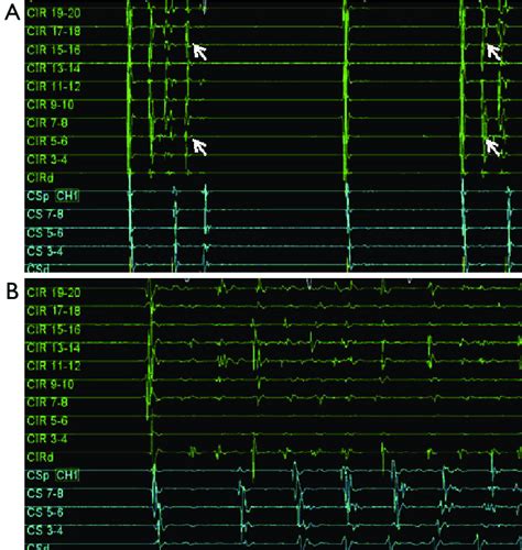 The Figure Shows The Intracardiac Electrograms Of A Patient With Download Scientific Diagram