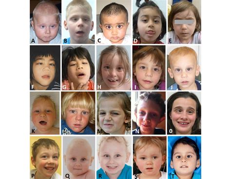Facial Phenotypes Of Individuals With Ctnnb1 Mutation Patient 1 At The