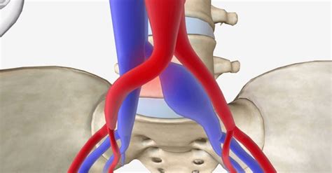 Compression Of Iliac Vein