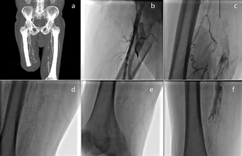 Figure 1 From Endovascular Retrograde Tibial Access For Limb Salvage In Chronic Limb Threatening