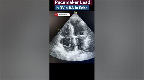 Pacemaker Lead Seen In Echo Shorts Youtube