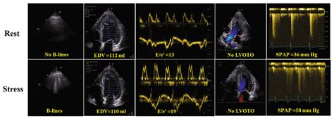 Example Of Exercise B Lines In A Non Obstructive Hcm Patient With Download Scientific Diagram