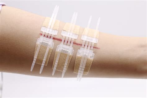 Zipstitch Wound Closure Device Longmed Zip Strip Sutures