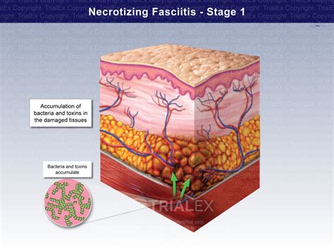 Necrotizing Fasciitis Stage 1 Trialquest Inc