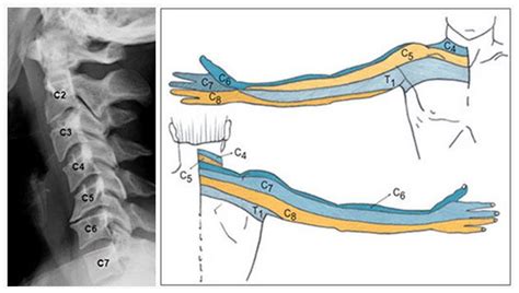 ШИПОВЕ НА ВРАТА МАГНЕЗИЙ Лечение