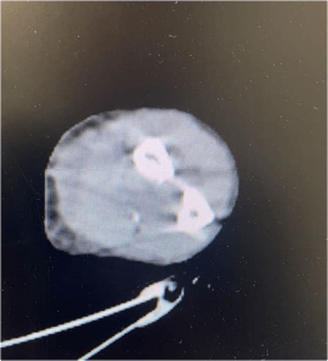 Computed Tomography Angiogram Of The Left Forearm Showing Hematoma