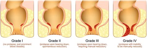 Basic Pathophysiology Of Hemorrhoids And Their Clinical Management