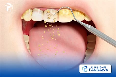 Scaling Gigi Pentingnya Perawatan Kesehatan Gigi Dan Gusi Klinik Pandawa
