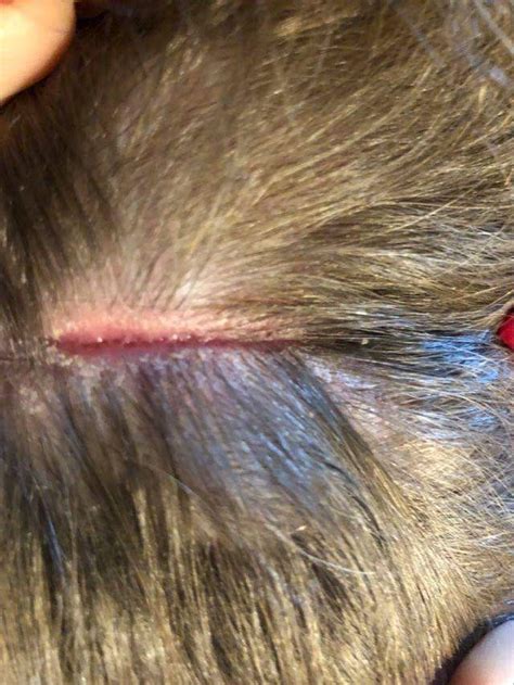 Anyone Else With A Scalp Crack That Wont Heal R Psoriasis