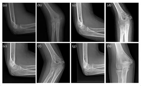 Epicondyle Fracture X Ray At Mary Ranney Blog