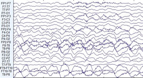 Towards Automated Epileptic Seizure Detection For Lightweight Devices Through Eeg Signal Processing