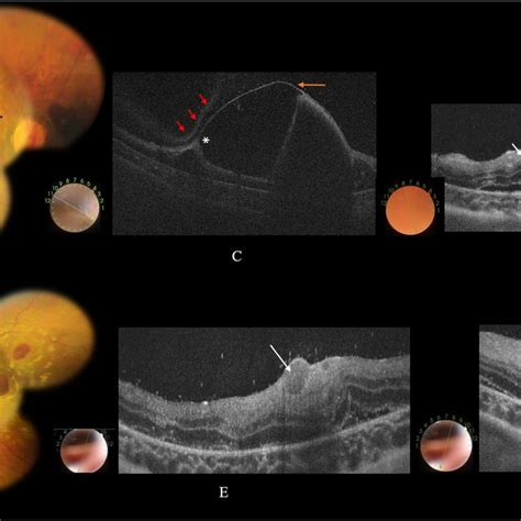 A B Fundus Photography Showing Bilateral Intraretinal And Preretinal