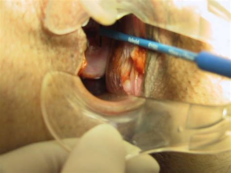 Histopathology Of The Uterine Cervix Digital Atlas
