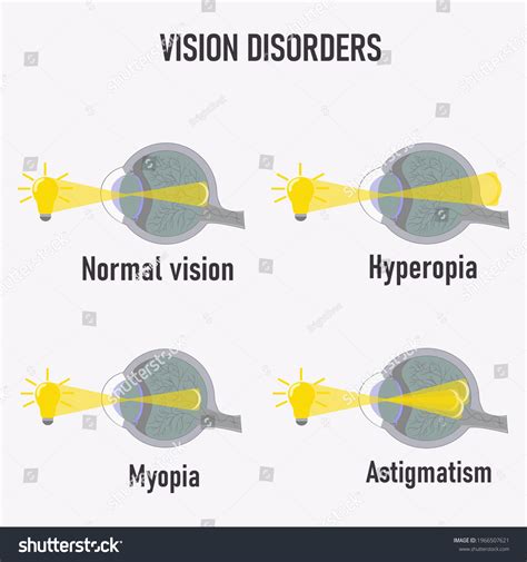 Common Visual Impairments Astigmatism Myopia Hyperopia Stock Vector