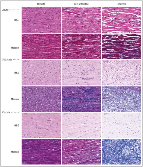 Histological Validation Of Cardiovascular Magnetic Resonance T Mapping For Assessing The