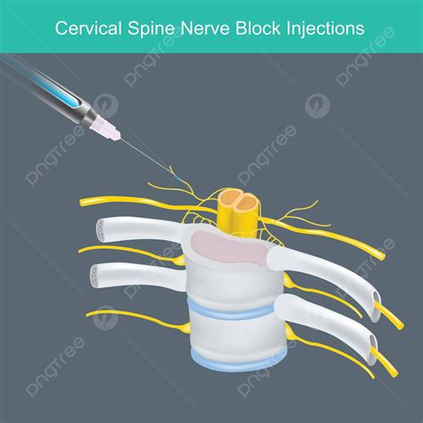 Illustration Of Cervical Spine Nerve Block Injections With Anesthetic Solution Vector Health