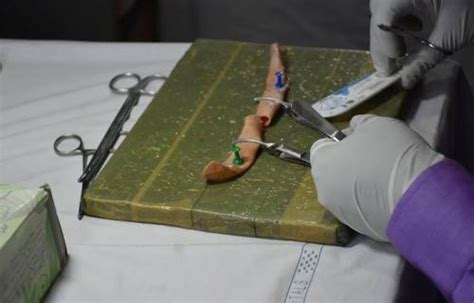 Tissue Approximation Program Ils Hospitals