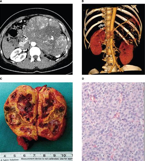 Characteristics Of Primary Adrenal Cortex Tumor A Ct Scan Result Of