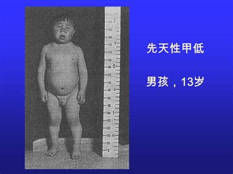 先天性甲状腺功能减低症 Congenital Hypothyroidism 先天性甲状腺功能减低症 congenital