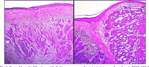 Figure 1 From Squamoid Eccrine Ductal Carcinoma A Diagnostic Semantic Scholar