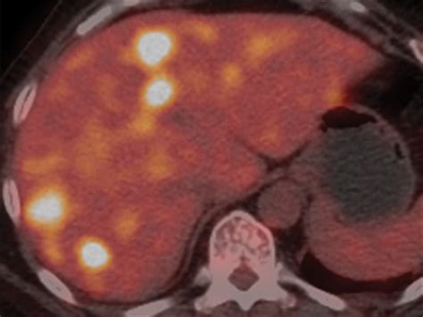 Hypervascular Nodular Hepatic Involvement In Multiple Myeloma A Case Report Journal Of