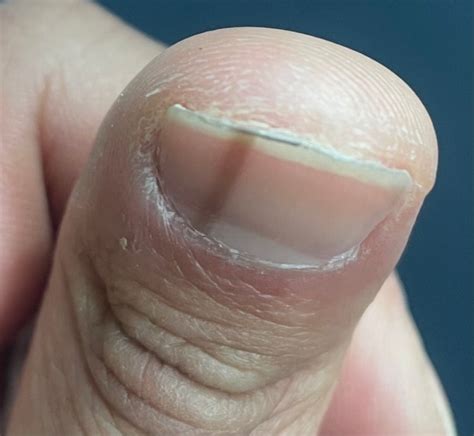 엄지 손가락 손톱 흑색종 지식in