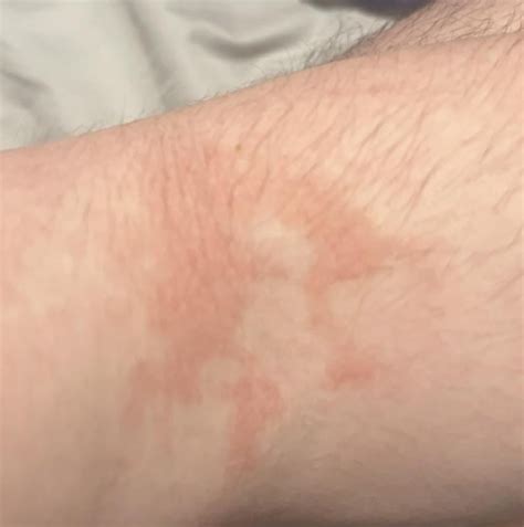 Rash R Skin