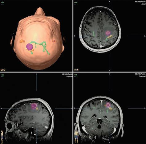 Brainsight Neuronavigation System At Zoe Walker Blog