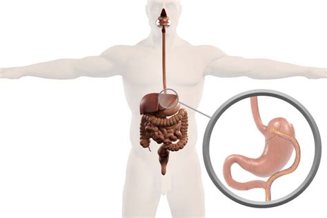 Laparoscopic Gastric Bypass Globehealer