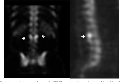 The Value Of Bone Scan And Pars Injection In Nonadjacent Pars Fractures Semantic Scholar