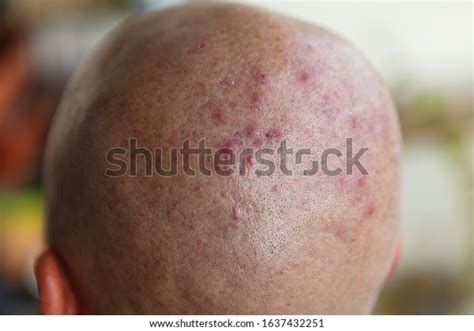 4 637 Scalp Diseases Images Stock Photos Vectors Shutterstock