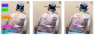 Pisa Syndrome And Parkinsons Disease Medfitnetwork