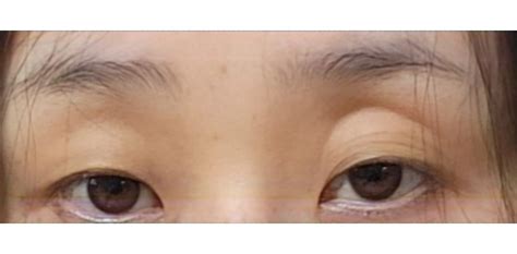 리얼후기 4 페이지 눈이 예쁘다 그래서 아몬드성형외과