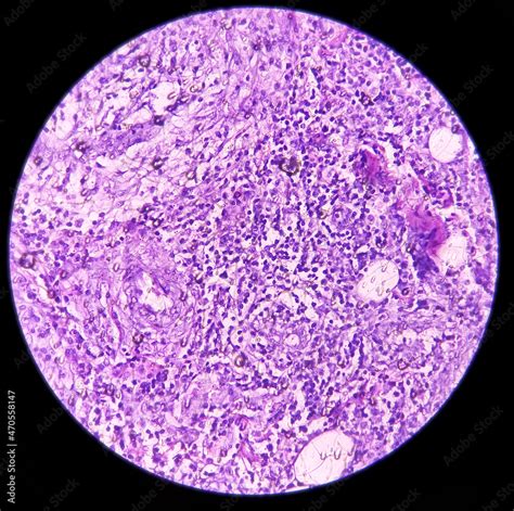 Photo And Art Print Pilonidal Disease Pilonidal Sinus Tract