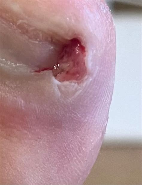 엄지발가락 진물 어떻게 해야하나요 지식in
