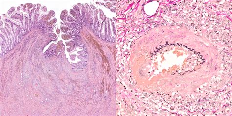Konsultations Und Referenzzentrum Für Vaskulitis Diagnostik