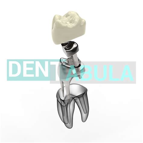 Разборная культивая вкладка #стоматология #цифроваястоматология # ...