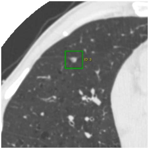 Association Between The Number And Size Of Intrapulmonary Lymph Nodes