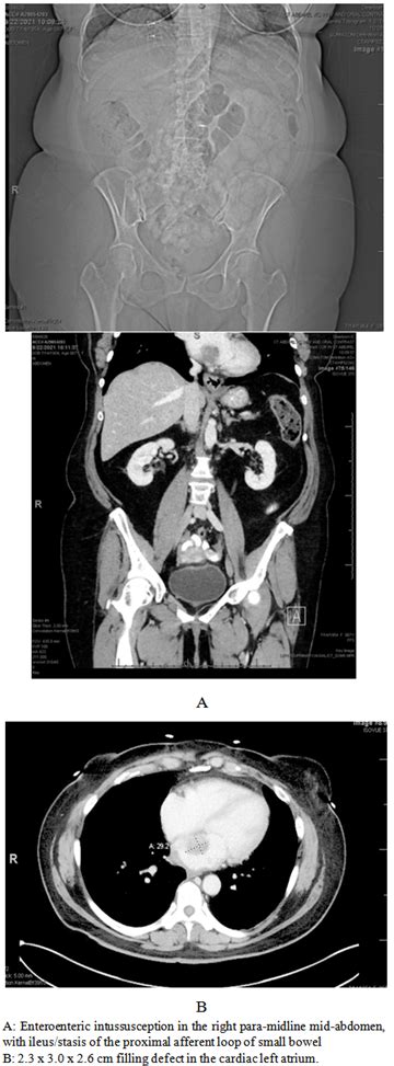 Figures Index A Rare Case Of High Grade Metastatic Intimal Sarcoma Cardiac Pleomorphic Sarcoma