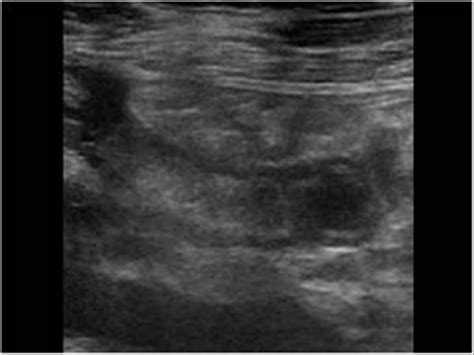 Abdomen And Retroperitoneum 1 5 Appendix Case 1 5 3 Complicated Appendicitis Ultrasound Cases