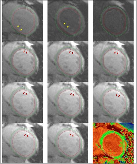 Illustration Of 1 Susceptibility Artefact Originating From The Download Scientific Diagram