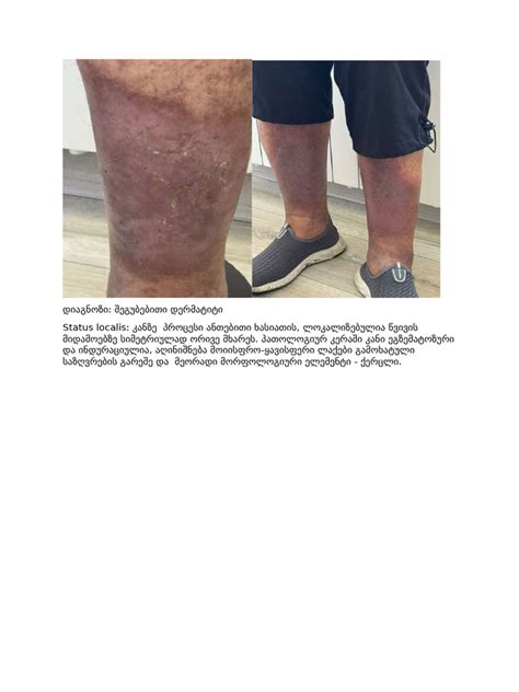 შეგუბებითი დერმატიტი Pdf