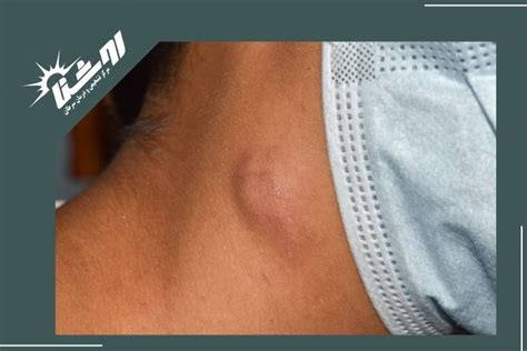 بهترین راه تشخیص سرطان غدد لنفاوی چیست؟ آنچه باید بدانید