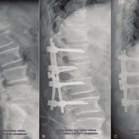 The Preoperative Cobb Angle Is A The Cobb Angle Is At Week Download Scientific